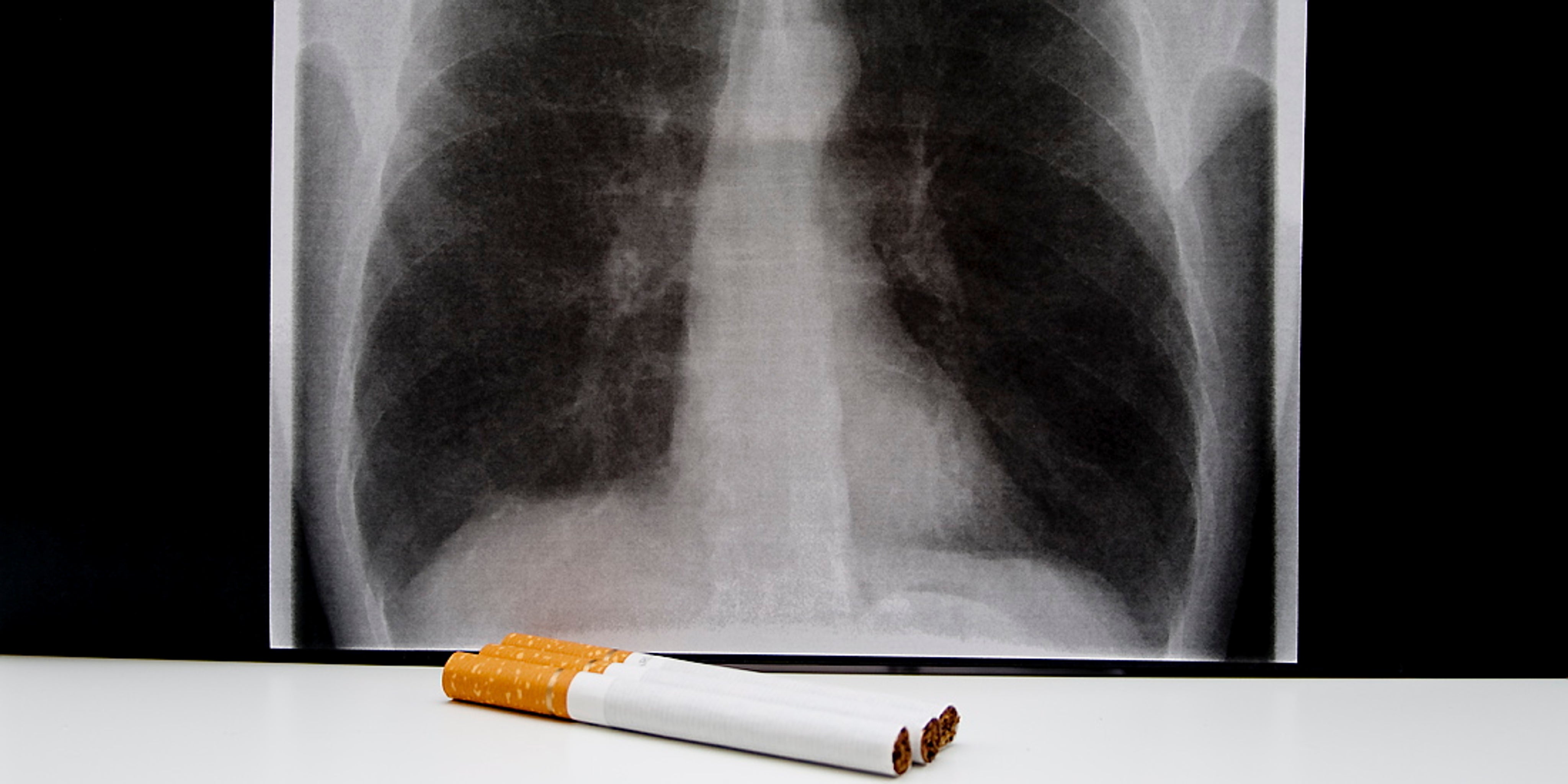 Spirometri vid kol ifrågasätts - Dagens Medicin